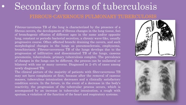 Primary and secondary forms of tuberculosis | PPTX | Blood Disorders ...