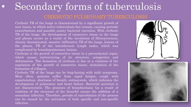 Primary and secondary forms of tuberculosis | PPTX | Blood Disorders ...