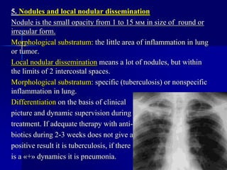Lecture 4-5. Radiological semiotics of lung and mediastinum pathology..ppt