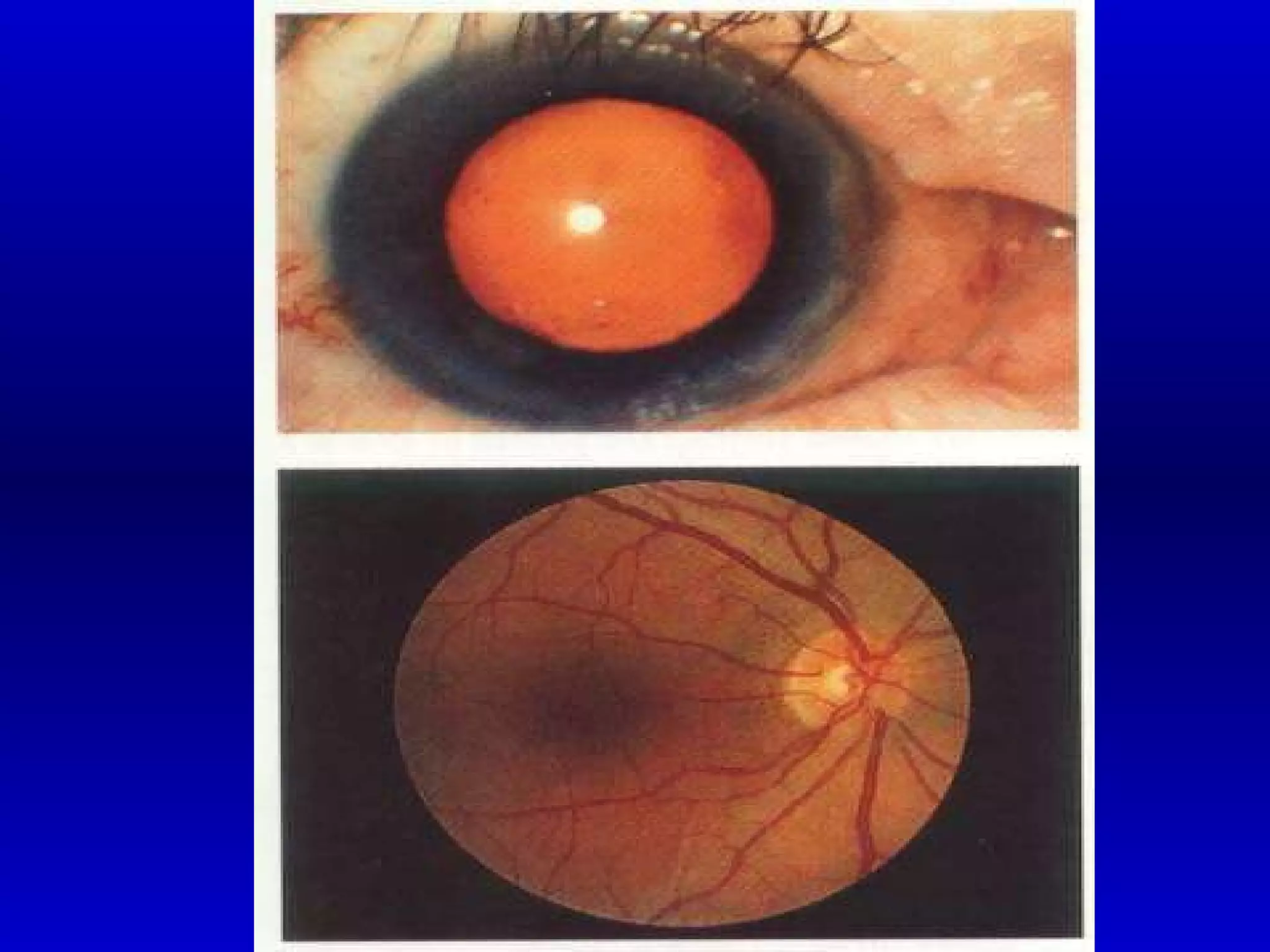 Lecture4 subjective and objective eye exam | PPT