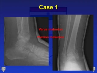 Lecture 40 parekh malunited ankle fracture | PPTX