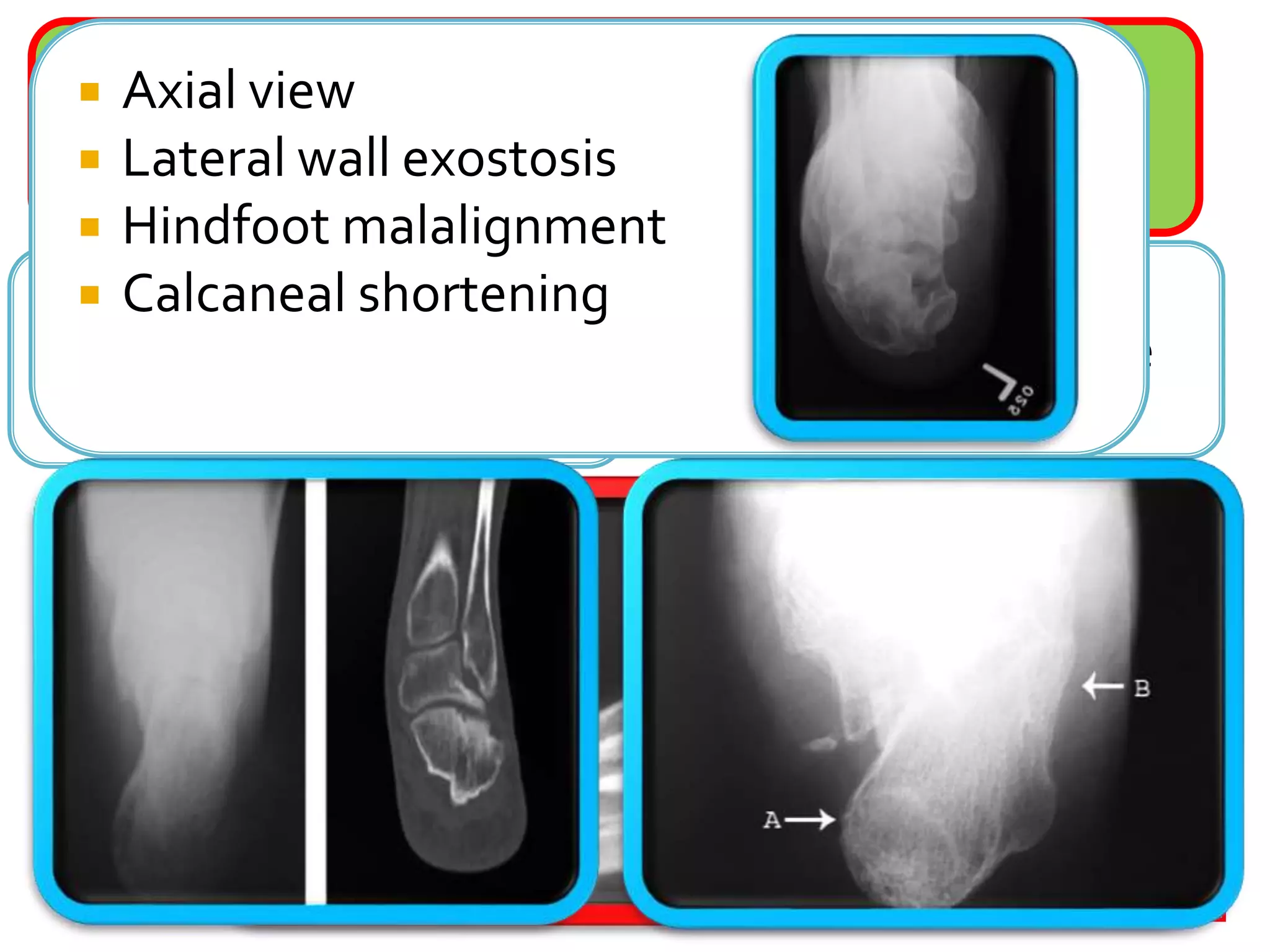 Lecture 42 shah calcaneal malunions | PPTX