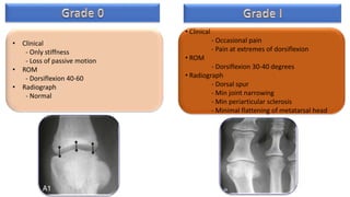 Lecture 45 shah hallux rigidus | PPTX
