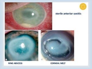 amoeba infecting brain and eyes | PPTX