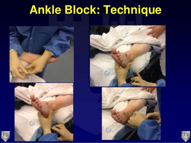 Lecture 4 and 5 parekh regional anesthesia