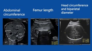 Lecture 4 Role of ultrasound in obstetrics | PPTX