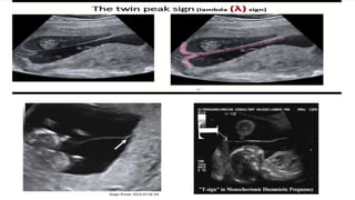 Lecture 4 Role of ultrasound in obstetrics | PPT