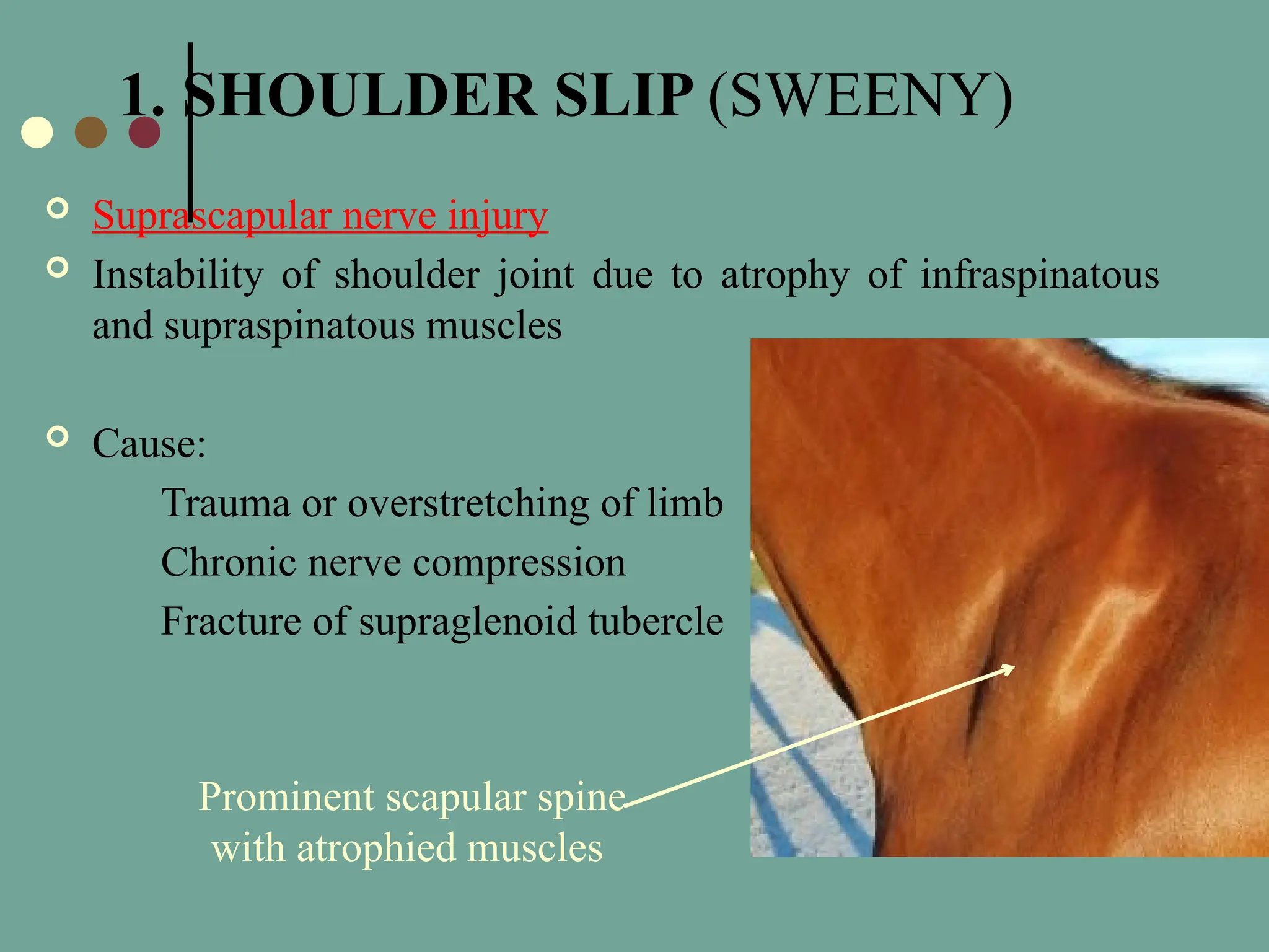 Lecture 4 Shoulder slip (sweeny)^J bicipital bursitis^J omarthritis^J ...