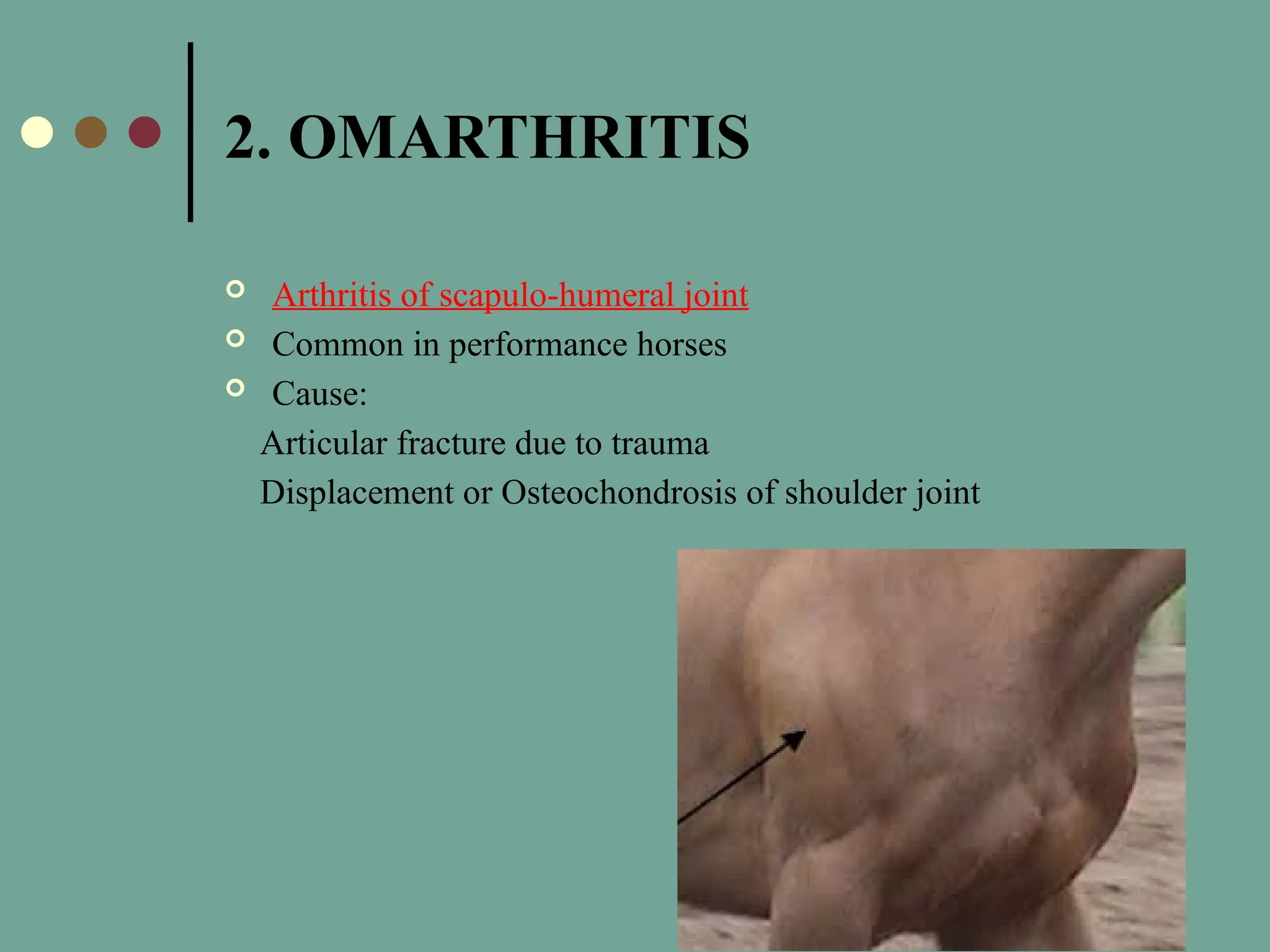 Lecture 4 Shoulder slip (sweeny)^J bicipital bursitis^J omarthritis^J ...