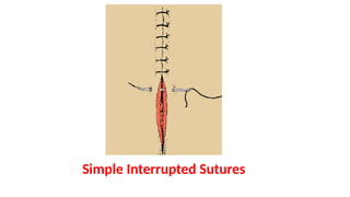 Lecture 4; Suture Materials, Suture Needles, Suture Patterns and ...