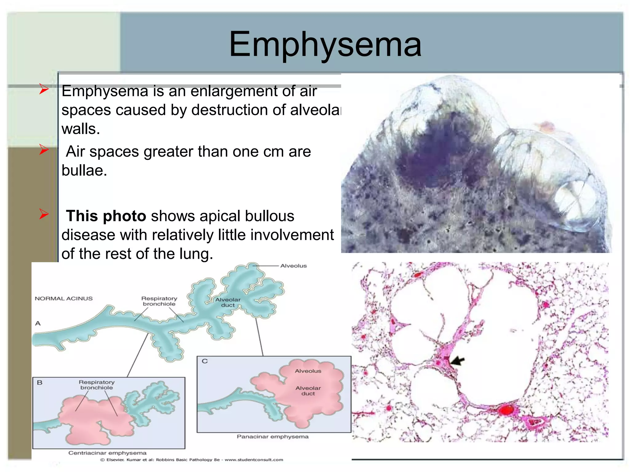 Lecture 5 asthma and copd | PPT