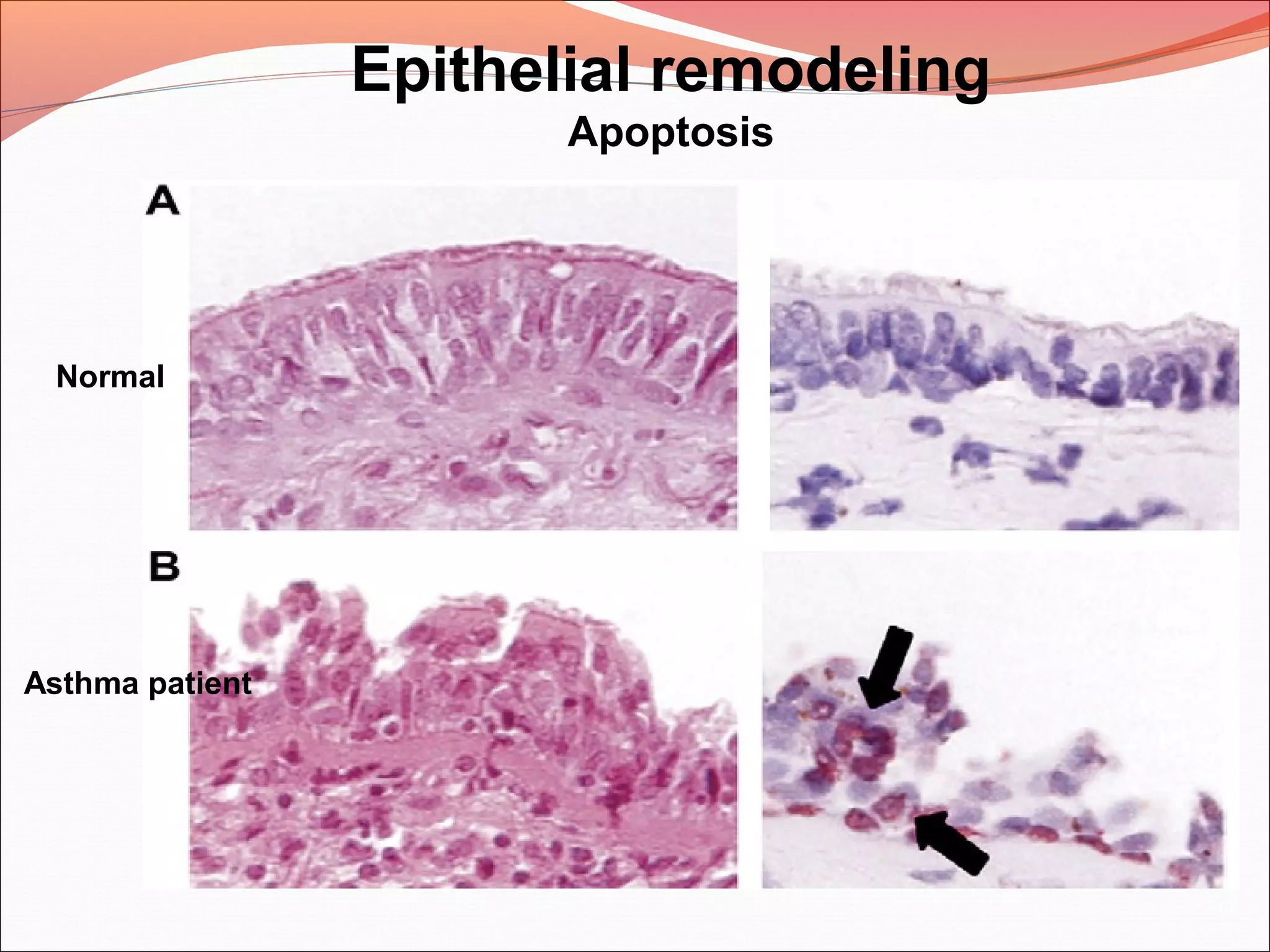 Lecture 5 asthma and copd | PPT