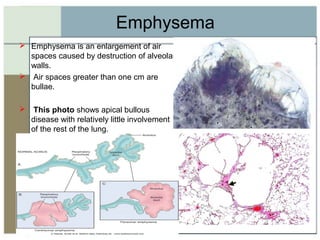 Lecture 5 asthma and copd | PPT