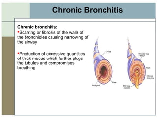 Lecture 5 asthma and copd | PPT