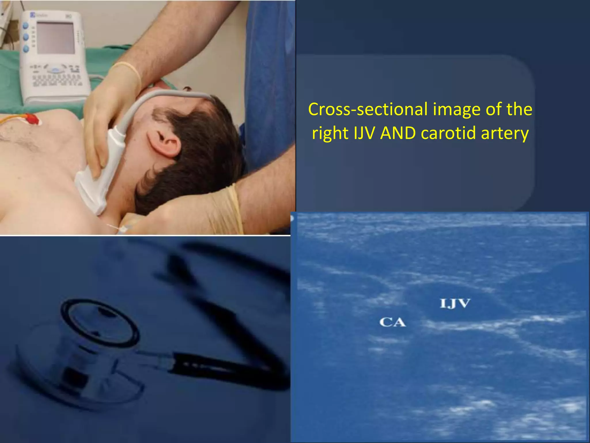 LECTURE5-Regional Anaesthesia Techniques Dr MASOUN (1).ppt