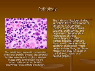 Lecture 5. typhoid fever 3 | PPT