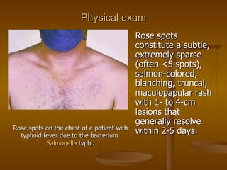Salmonella Typhi Rose Spots
