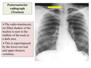 lecture 5 - X-ray chest.ppt