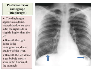 lecture 5 - X-ray chest.ppt