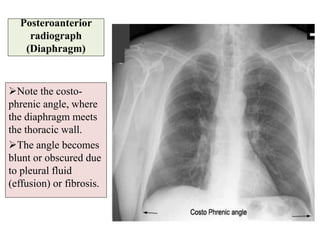 lecture 5 - X-ray chest.ppt