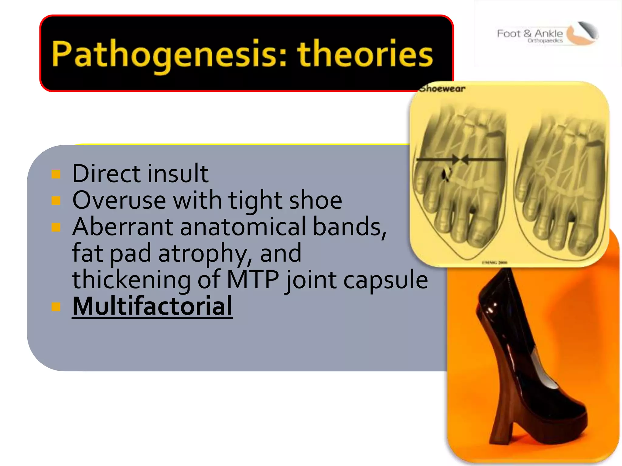 Lecture 50 shah morton neuroma | PPTX