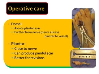 Lecture 50 shah morton neuroma | PPTX