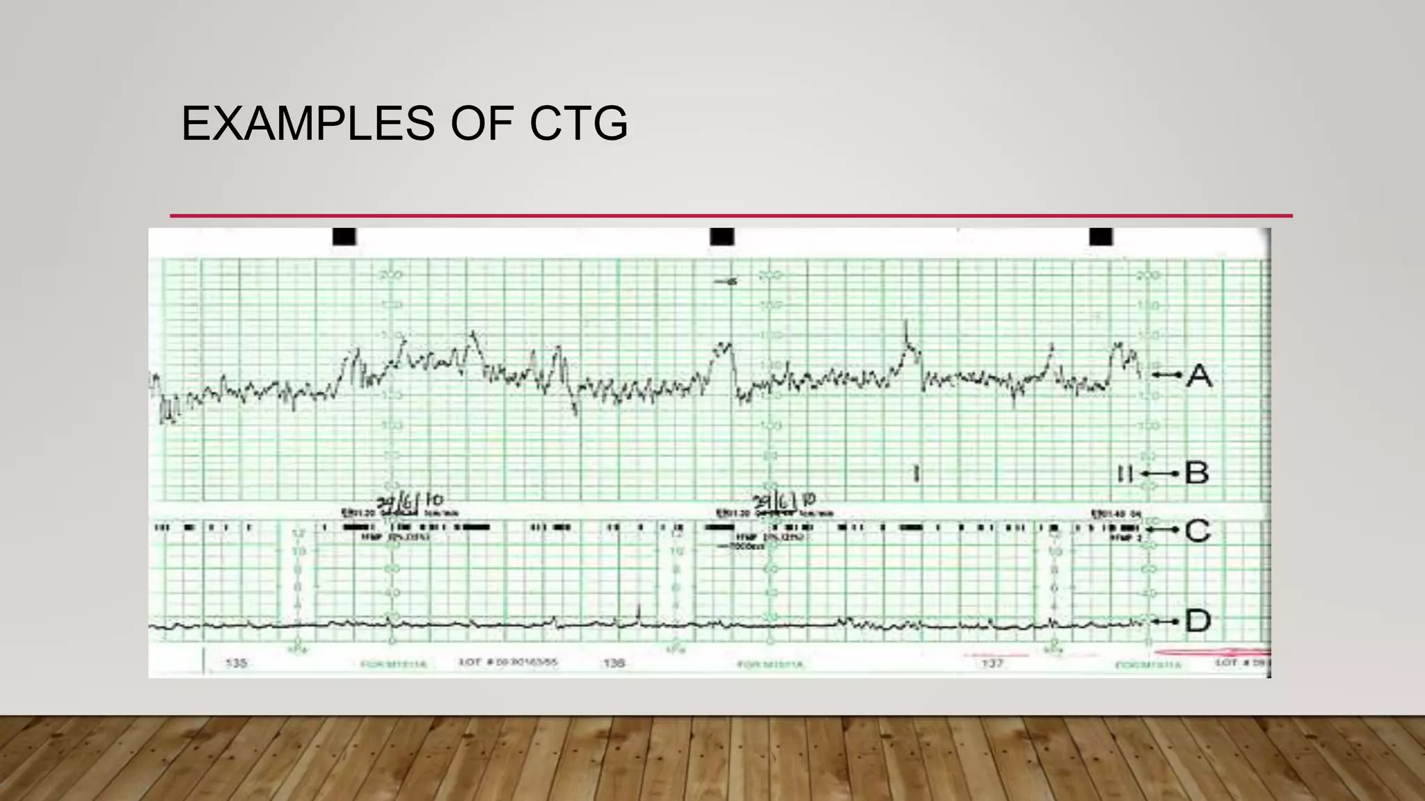 Lecture 5 Assessment of fetal wellbeing | PPTX