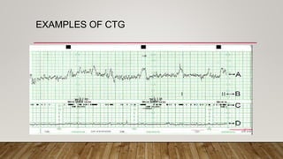 Lecture 5 Assessment of fetal wellbeing | PPTX