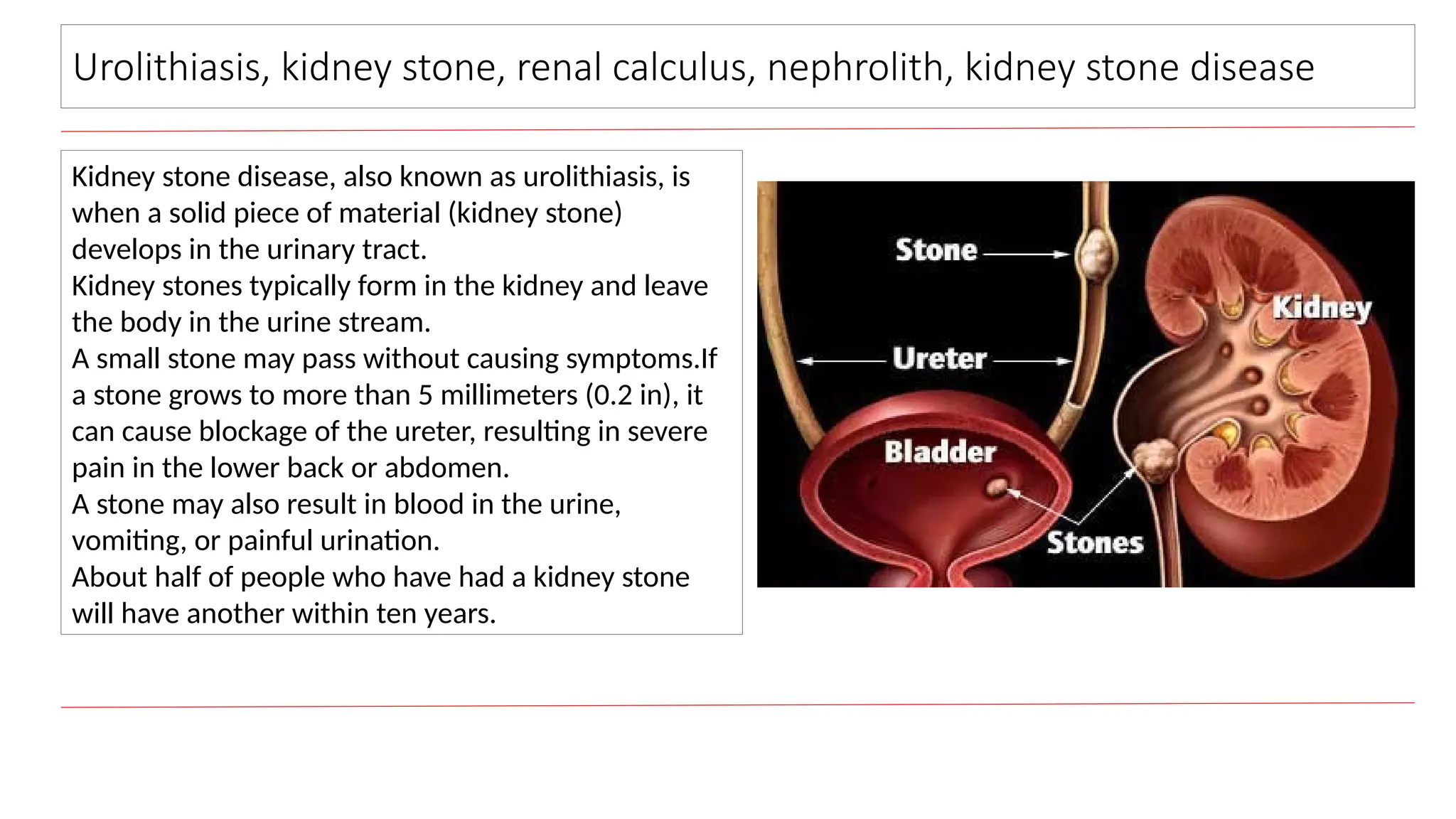 Moder lecture lecture 5 Urolithiasis.pptx