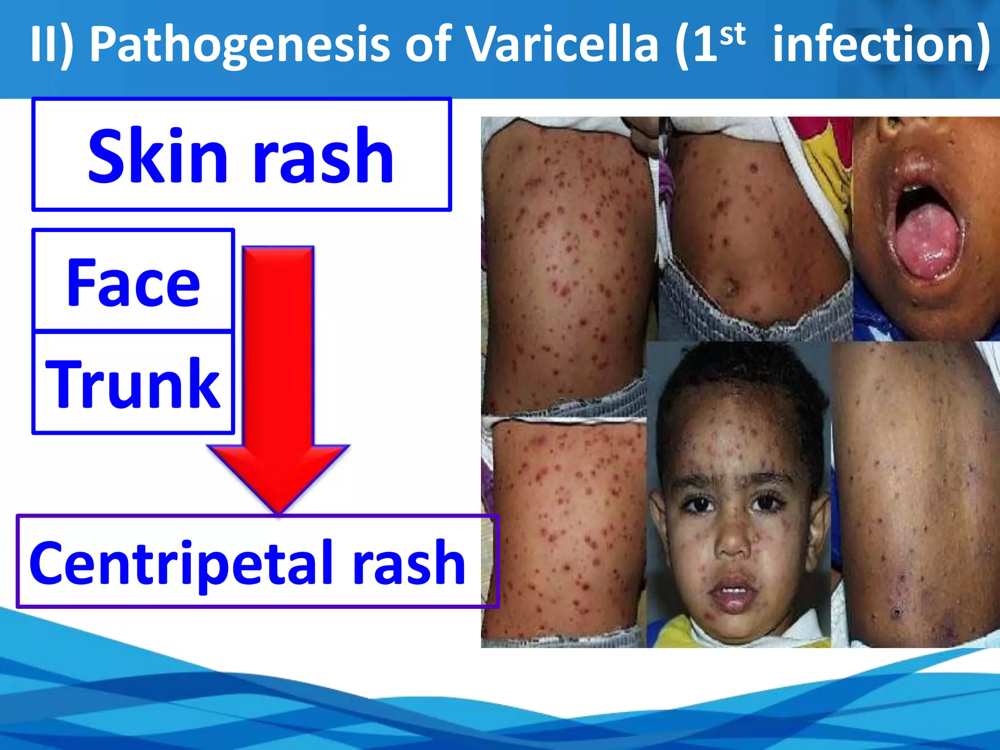 Lecture 5 Varciella-Zoster virus.pptx