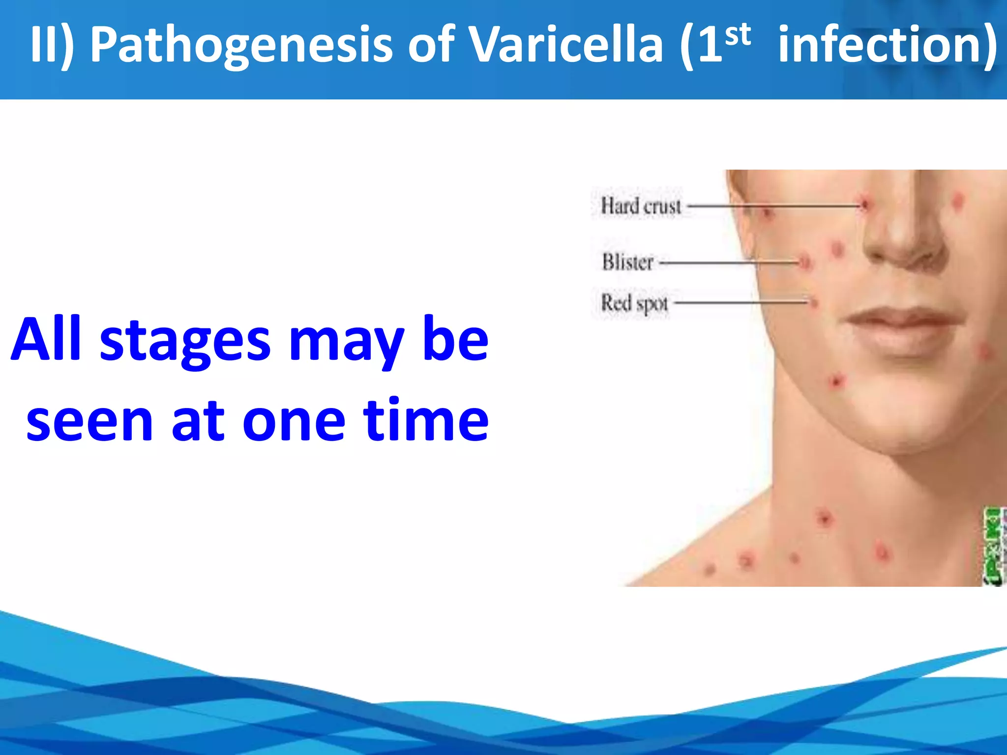 Lecture 5 Varciella-Zoster virus.pptx