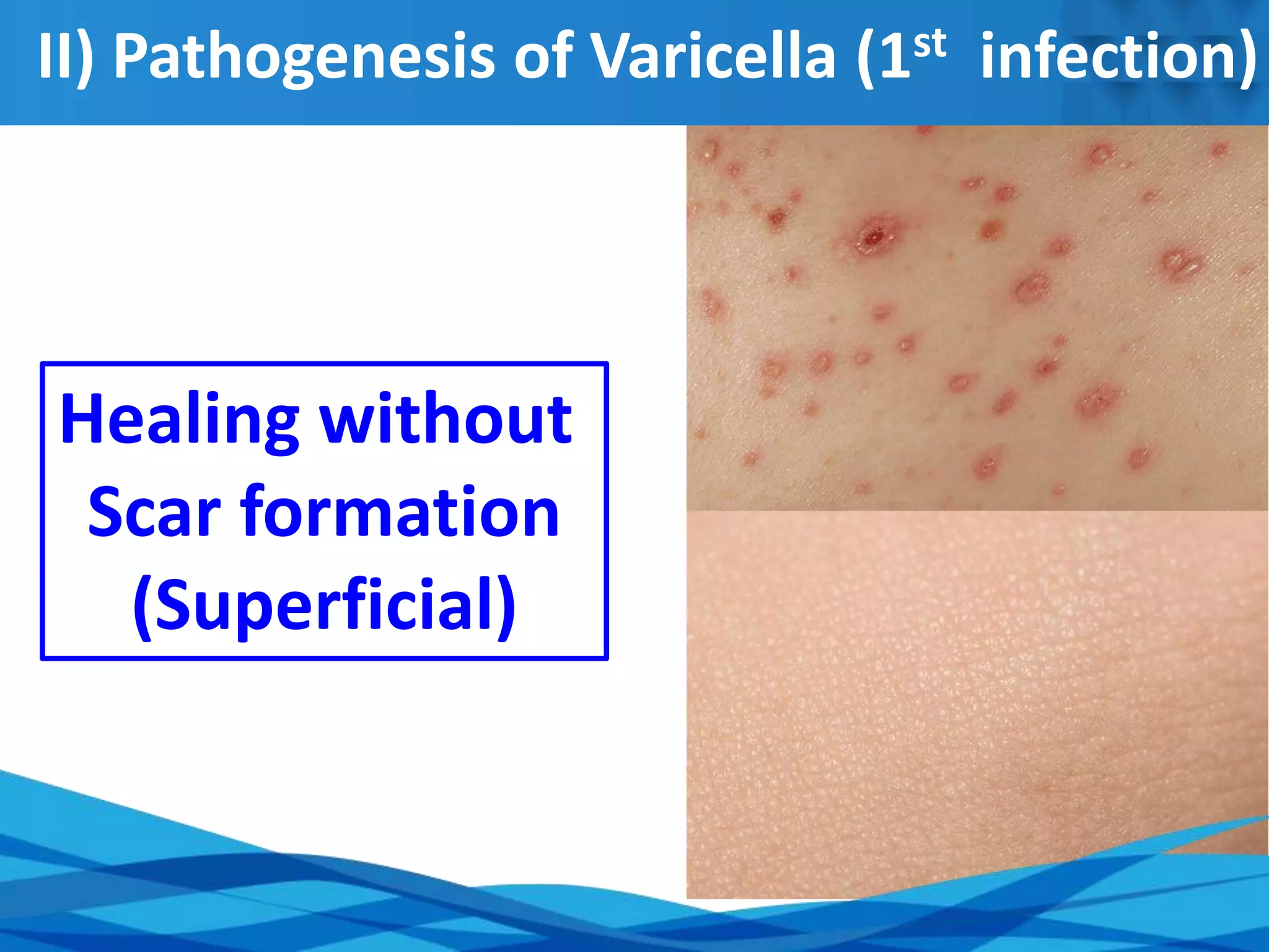 Lecture 5 Varciella-Zoster virus.pptx