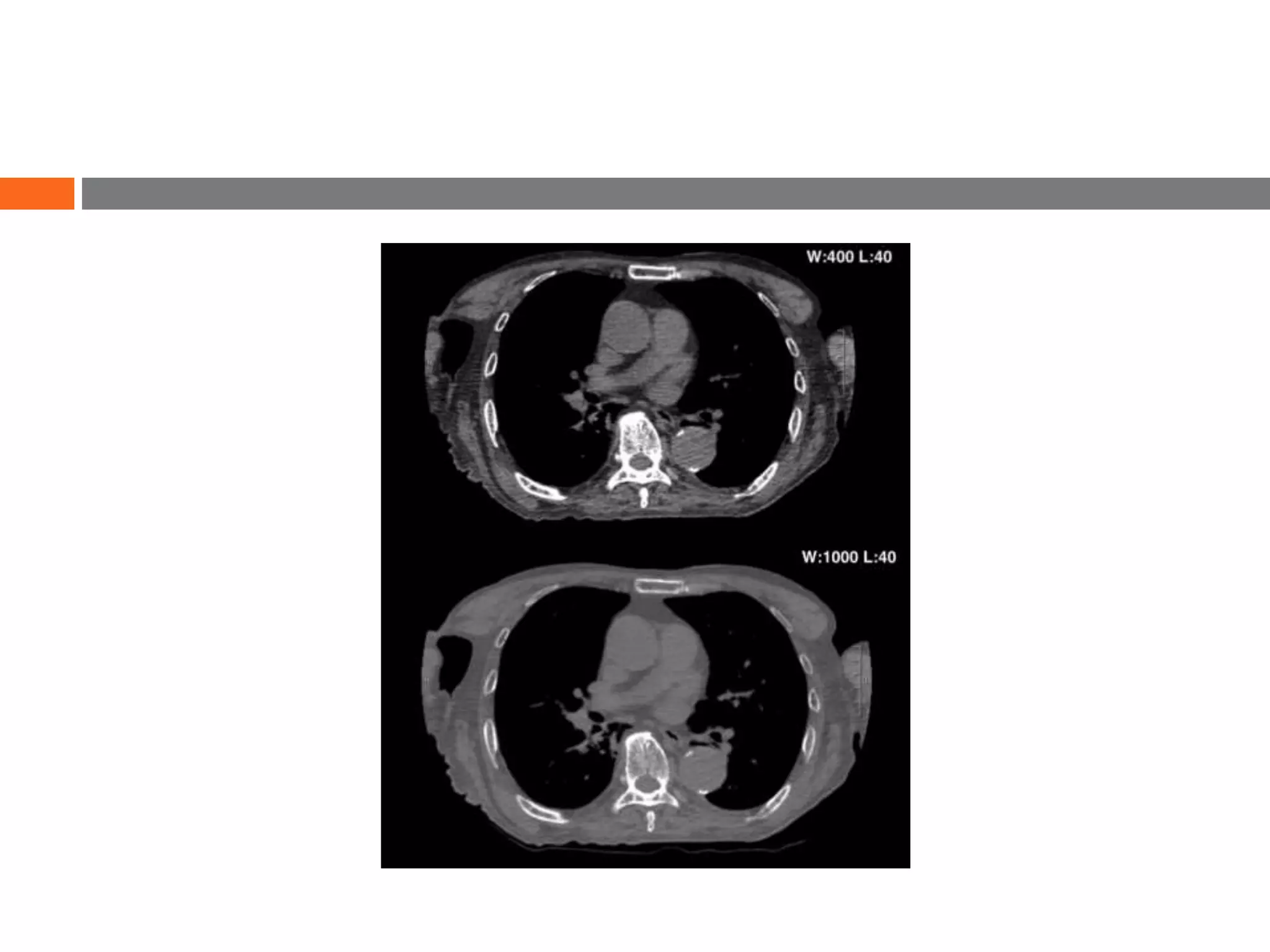 UNDERSTANDING CT SCAN windowing | PPTX | Brain and Nervous System ...