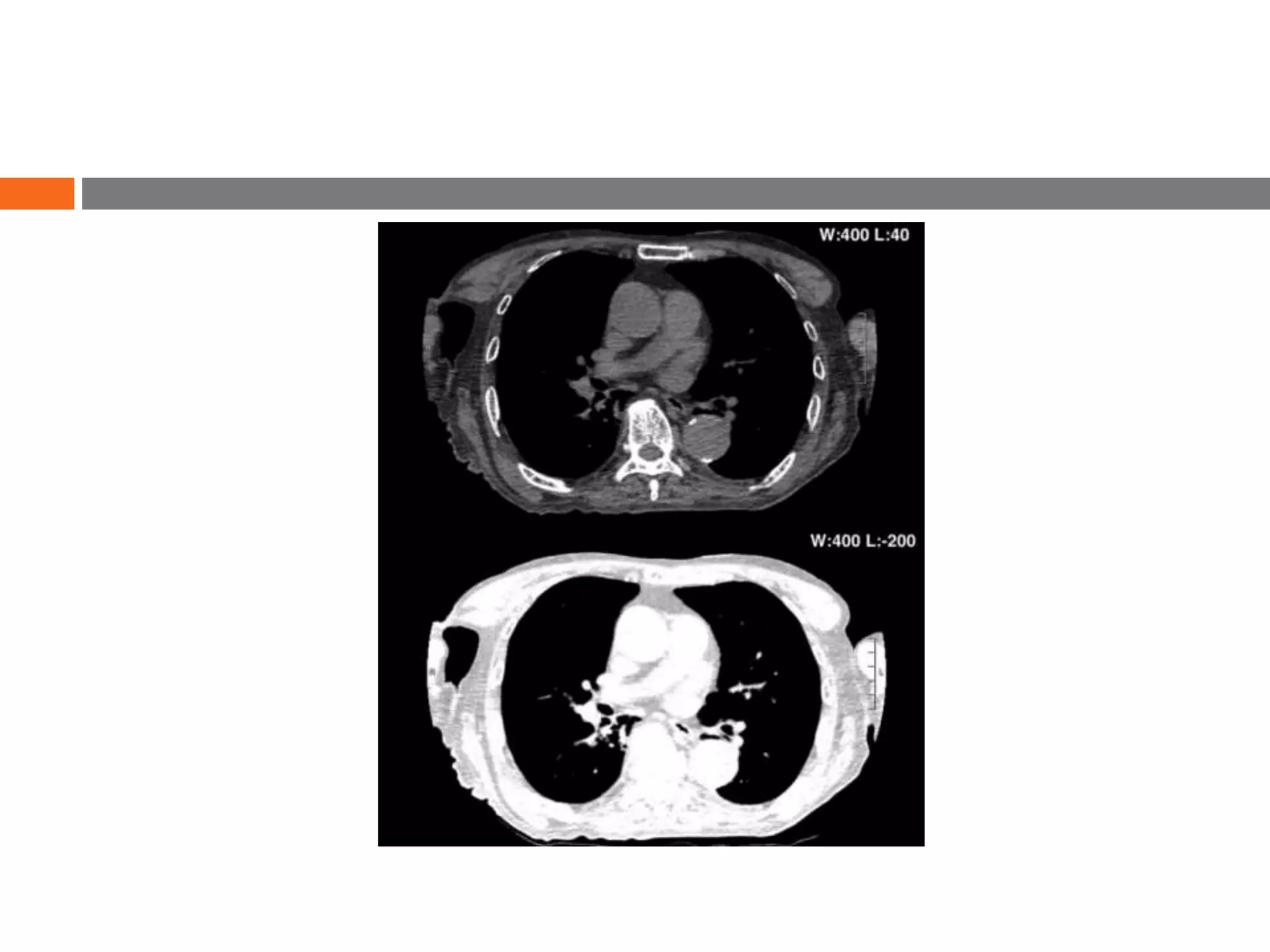 UNDERSTANDING CT SCAN windowing | PPTX