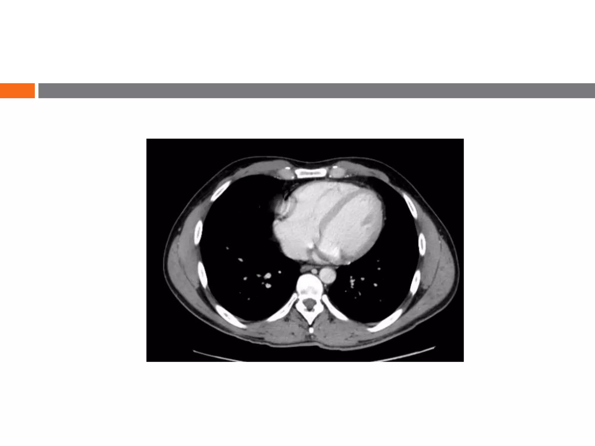 UNDERSTANDING CT SCAN windowing | PPTX