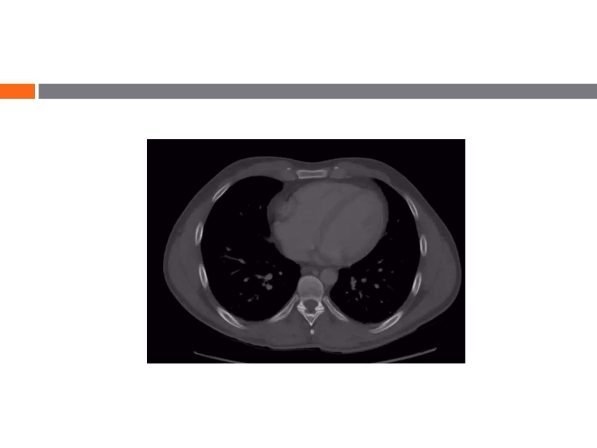 UNDERSTANDING CT SCAN windowing | PPTX