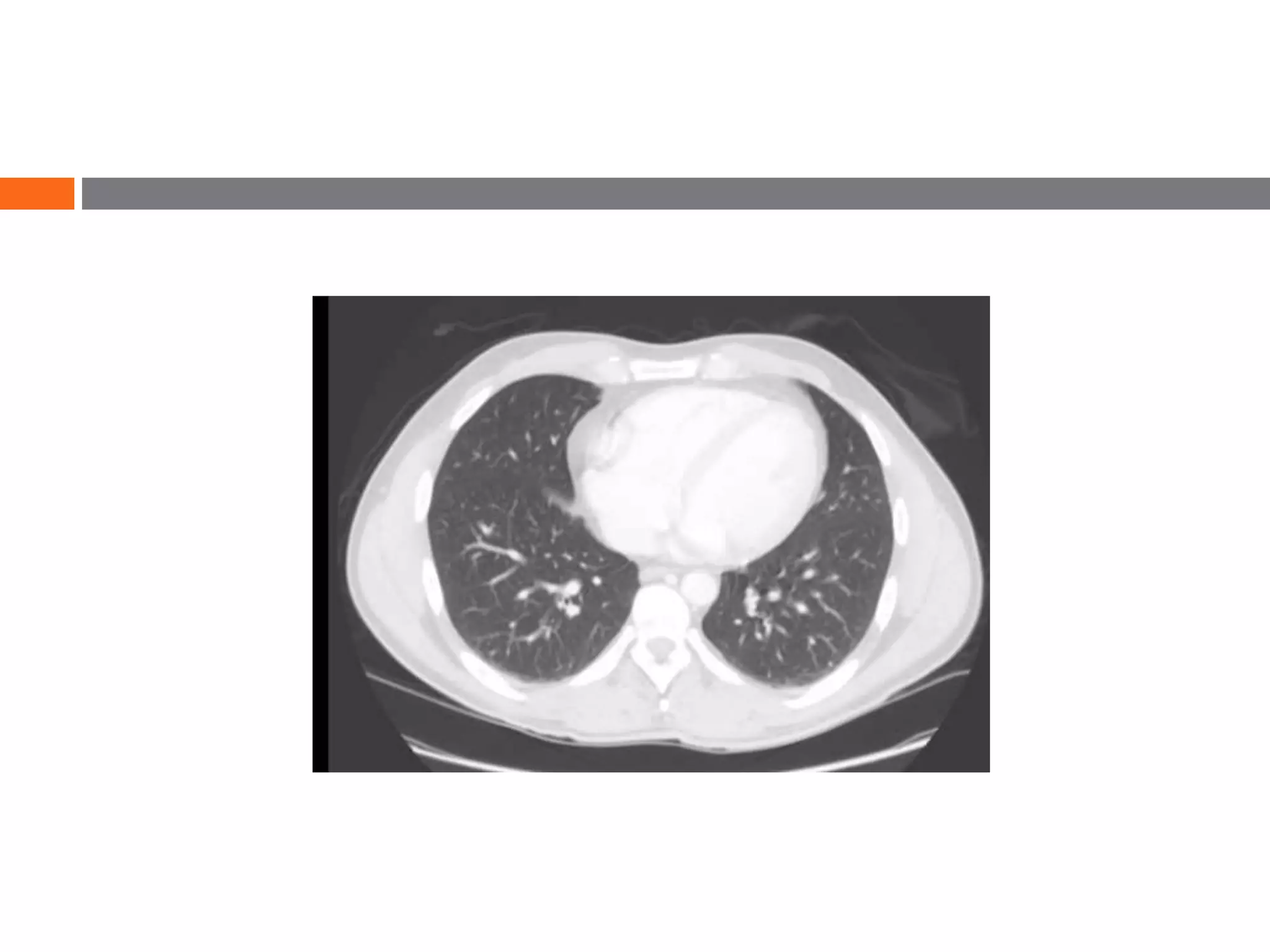 UNDERSTANDING CT SCAN windowing | PPTX