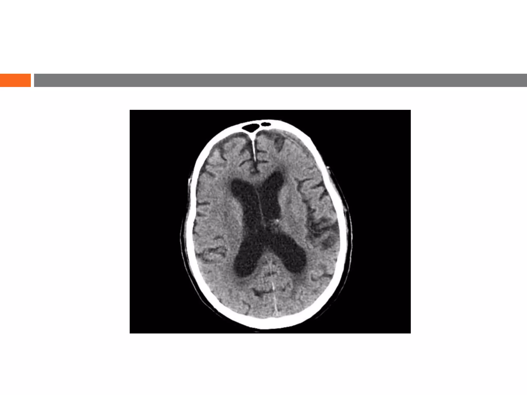 UNDERSTANDING CT SCAN windowing | PPTX