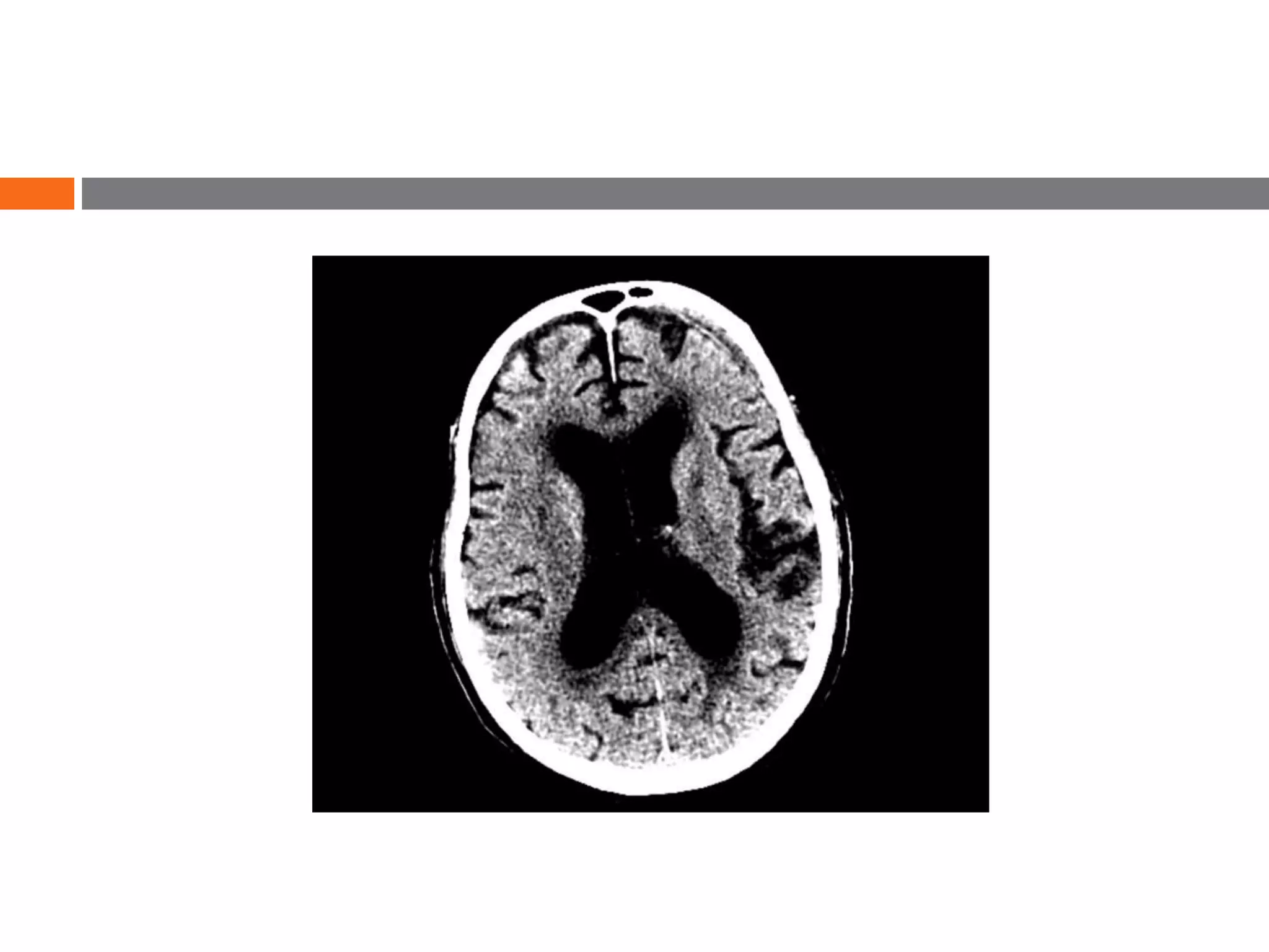 UNDERSTANDING CT SCAN windowing | PPTX