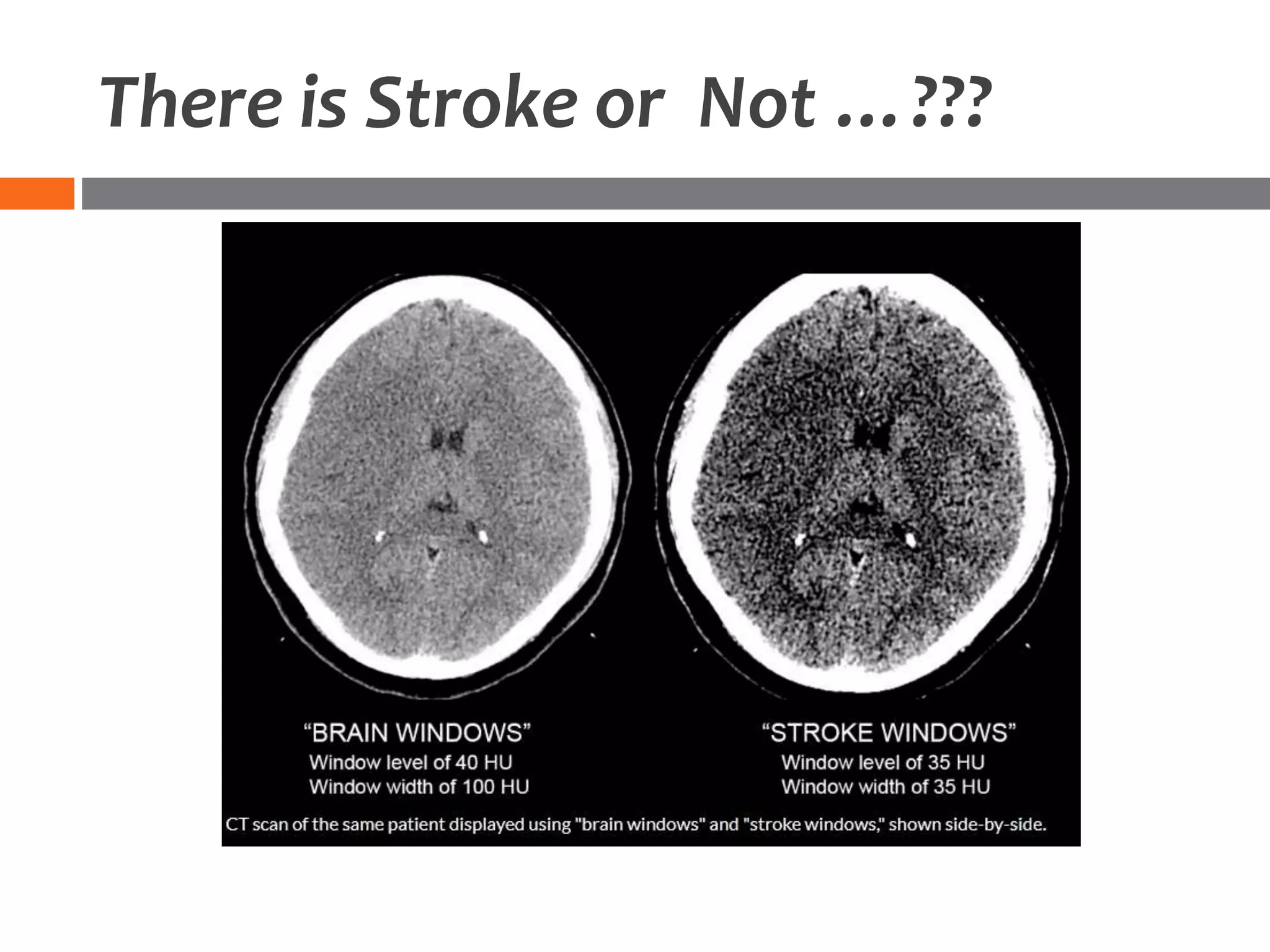 UNDERSTANDING CT SCAN windowing | PPTX