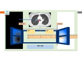UNDERSTANDING CT SCAN windowing | PPTX