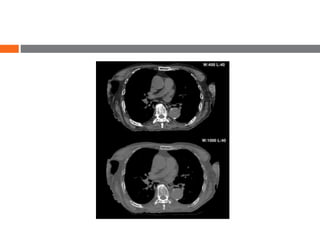 UNDERSTANDING CT SCAN windowing | PPT