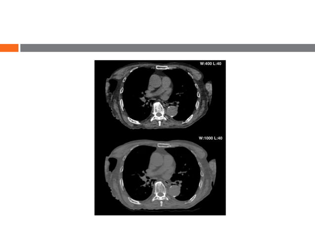 UNDERSTANDING CT SCAN windowing | PPTX