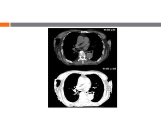 UNDERSTANDING CT SCAN windowing | PPT