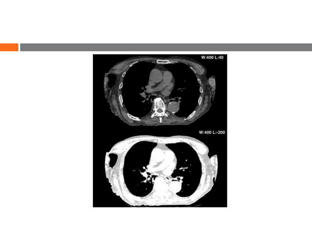 UNDERSTANDING CT SCAN windowing | PPTX