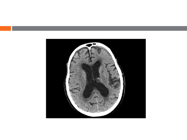 UNDERSTANDING CT SCAN windowing | PPTX