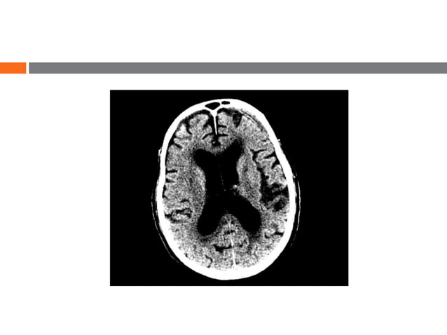 UNDERSTANDING CT SCAN windowing | PPTX