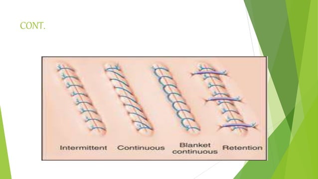 SURGICAL SUTURES | PPTX | First Aid | Injuries