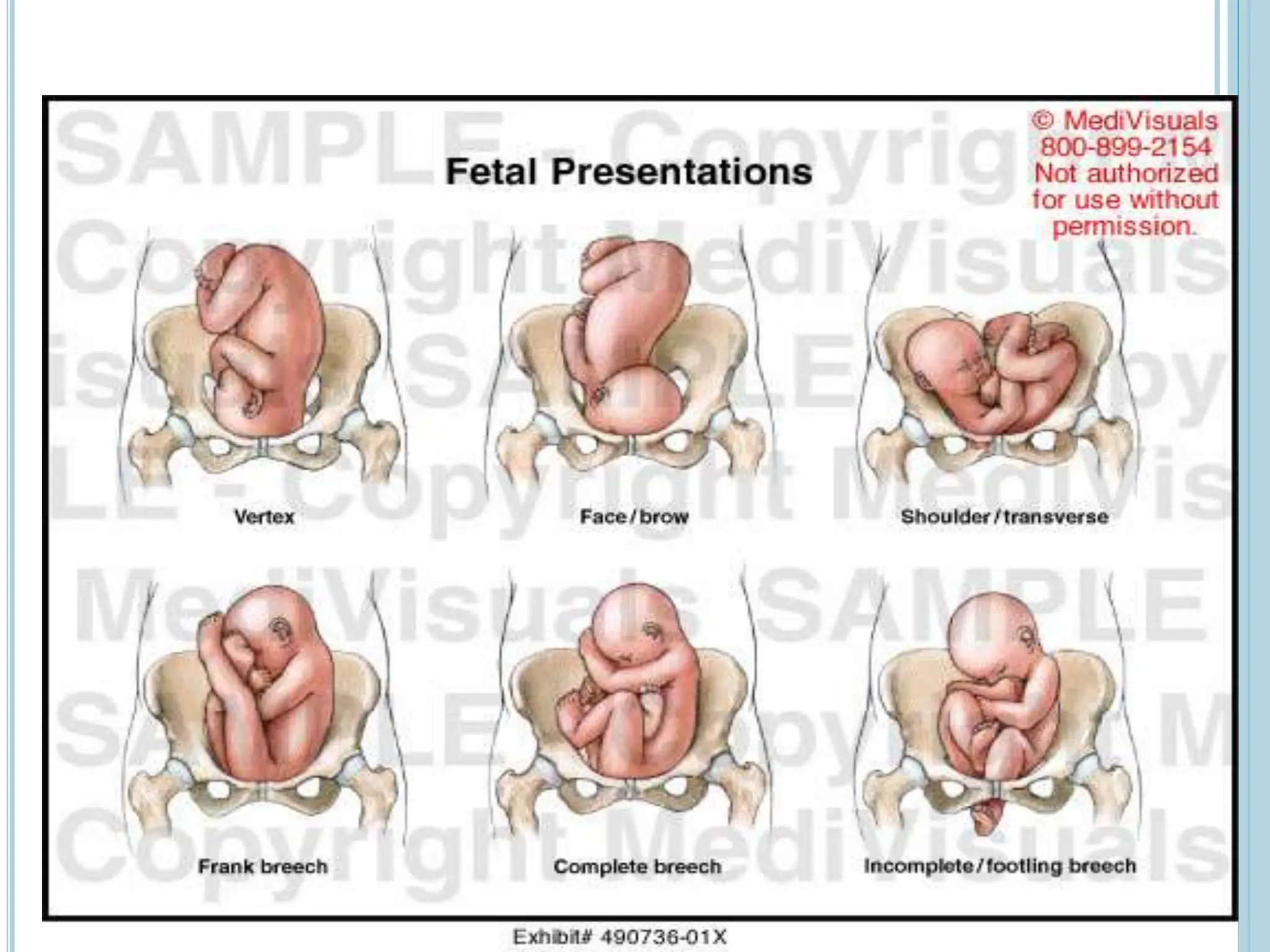 lecture_6_malpresentation, fetal position | PPT