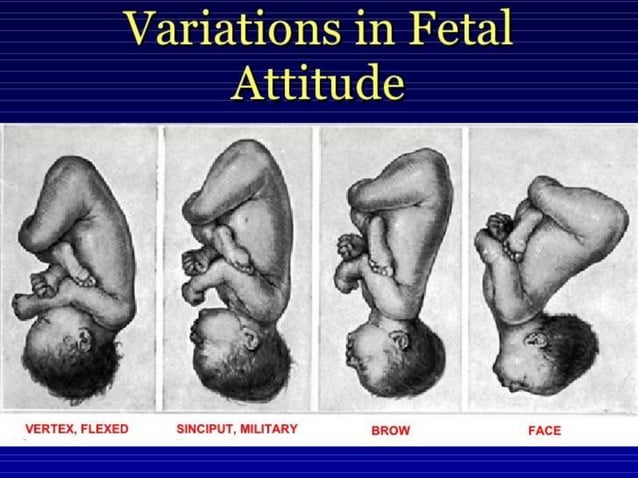 lecture_6_malpresentation, fetal position | PPT